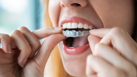 What Should I Do If My Invisalign Doesn't Fit? | Transcendent Smiles